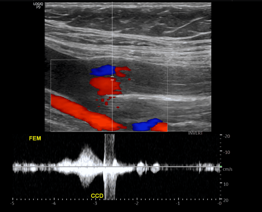 Ultrasonido Doppler Arterial y Venoso de Miembros Inferiores y ...